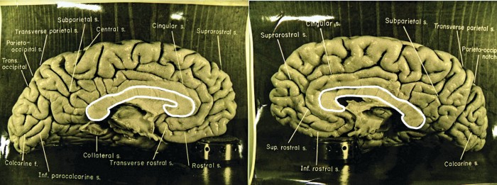 Albert Einstein Brain Vs Normal Brain