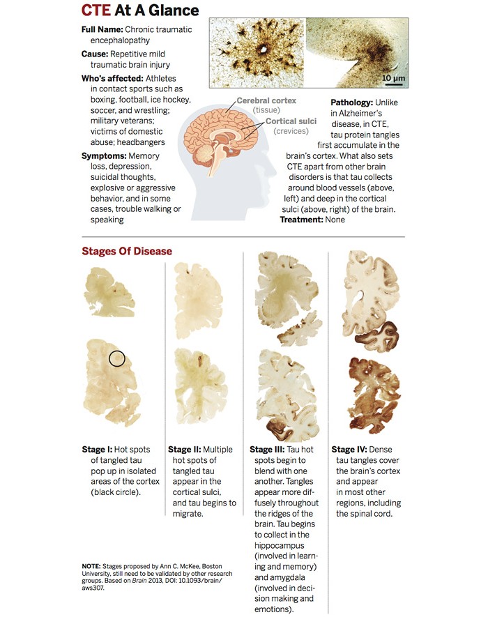 Chronic Traumatic Encephalopathy Stages