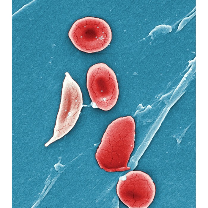 NIH-Program-Keeps-Sickle-Cell