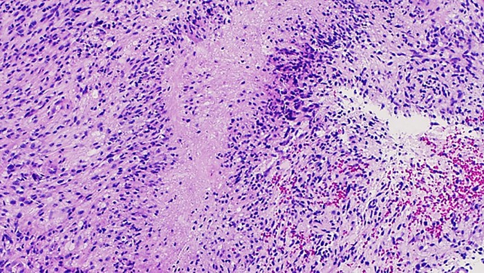 UCSF researchers pinpoint cancer immortality target﻿﻿﻿﻿