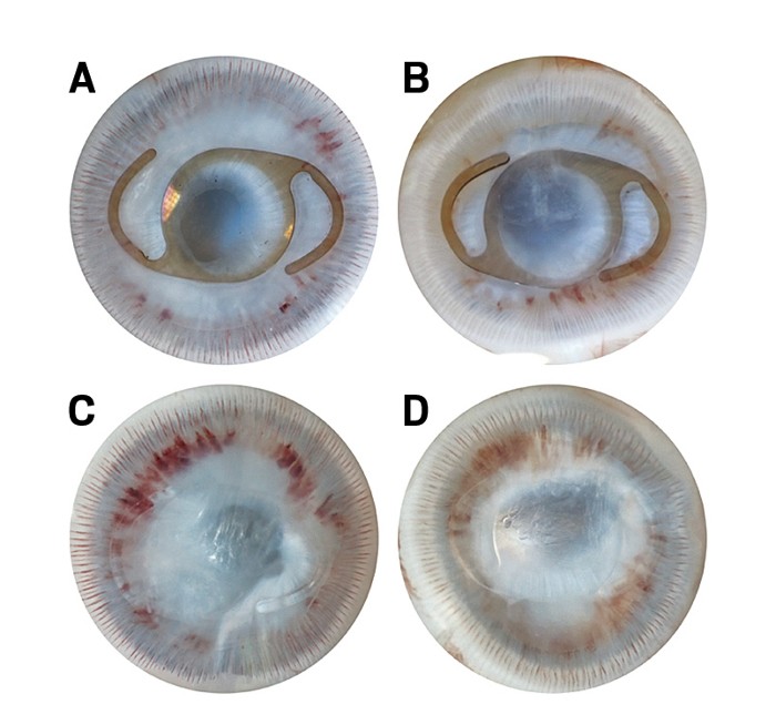Polymer-coated lenses could help prevent a common cataract surgery ...