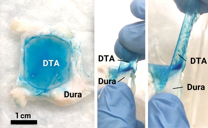 Tough adhesive could aid in neurosurgery