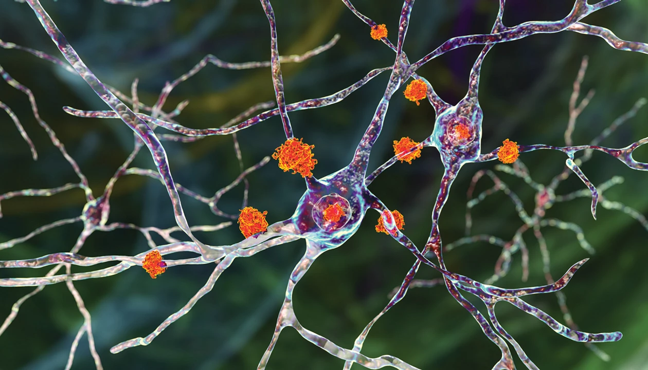 DNA repeat expansion drives Huntington’s development