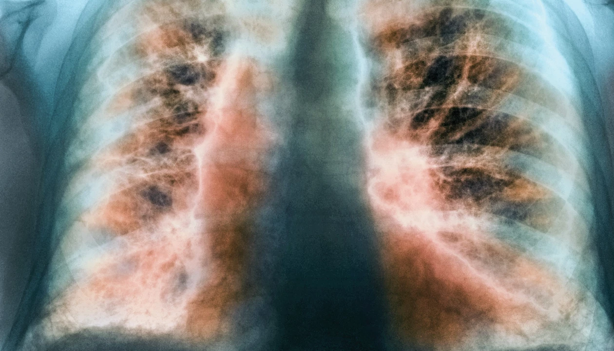 Celea sets sail with a deuterated drug for chronic lung disease
