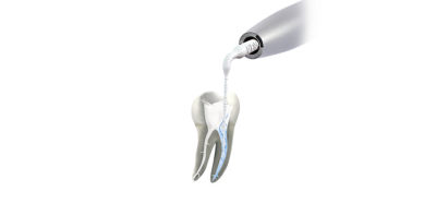 EDDY | Sonic-Powered Irrigation | Dentsply Sirona Global
